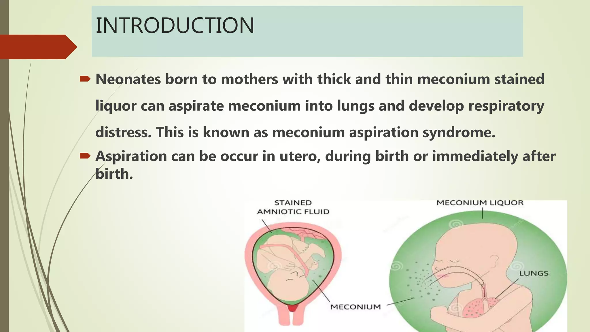 Meconium aspiration syndrome | PPTX
