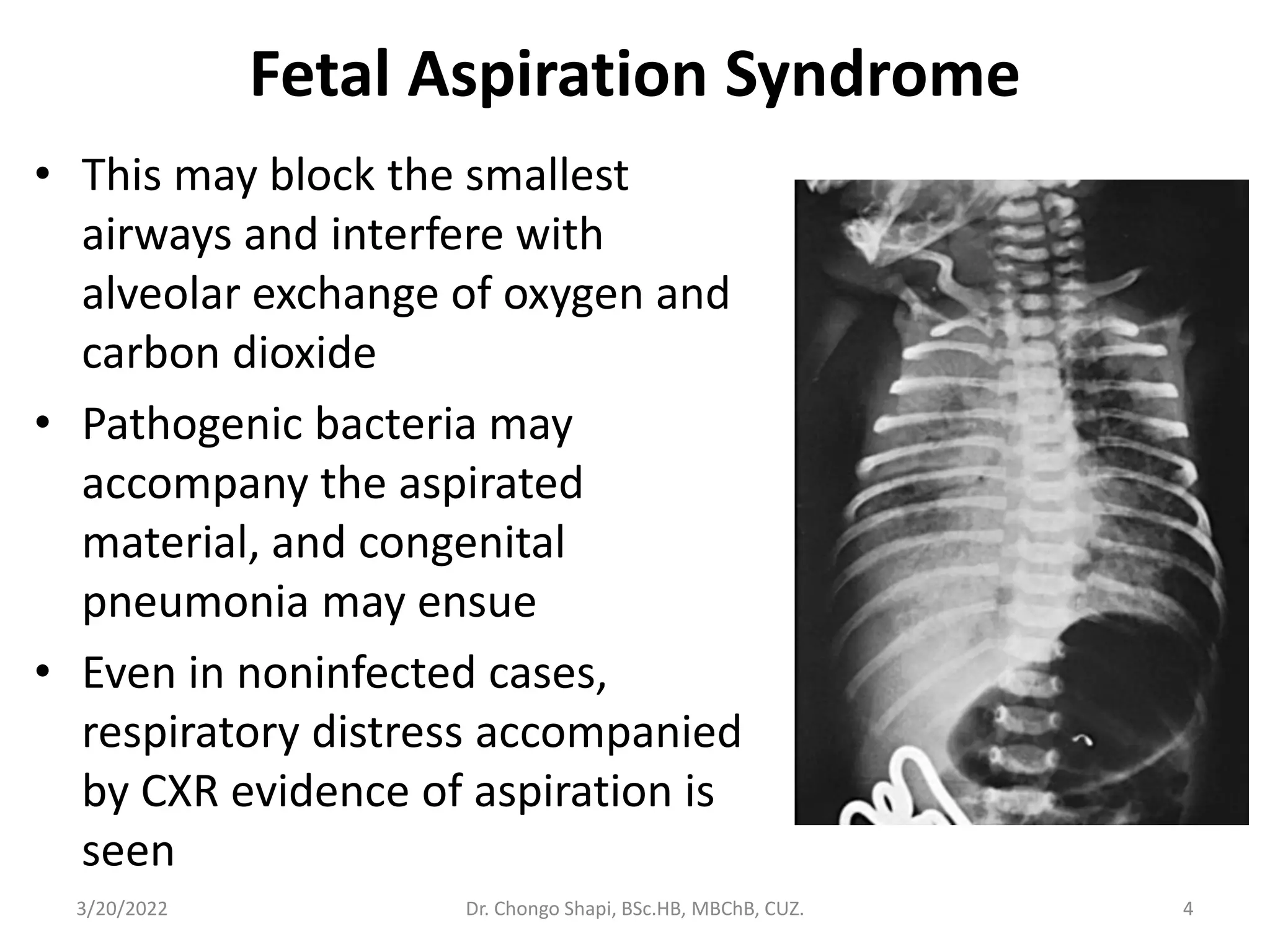 Meconium Aspiration Syndrome.pdf