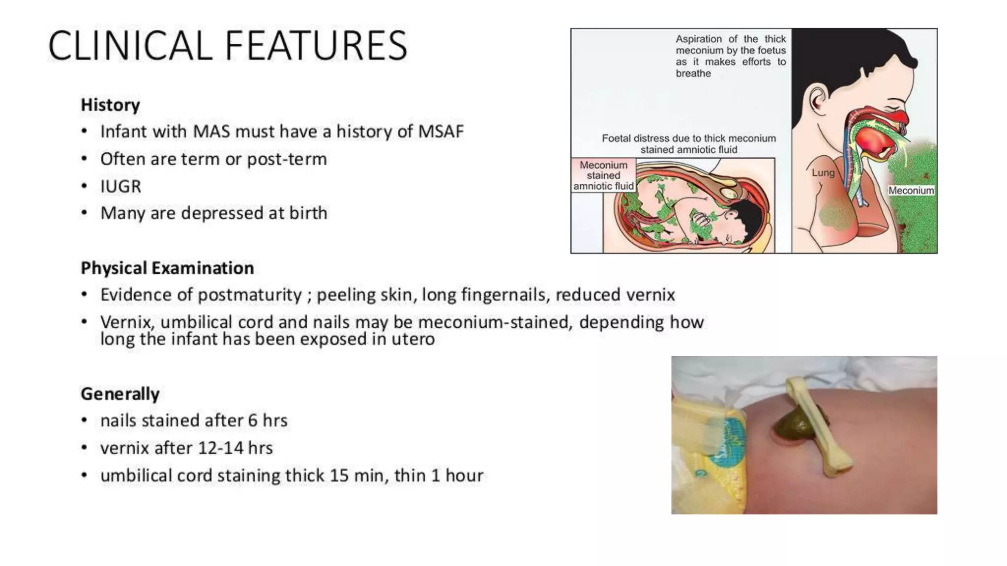 Meconium Aspiration syndrome.pptx