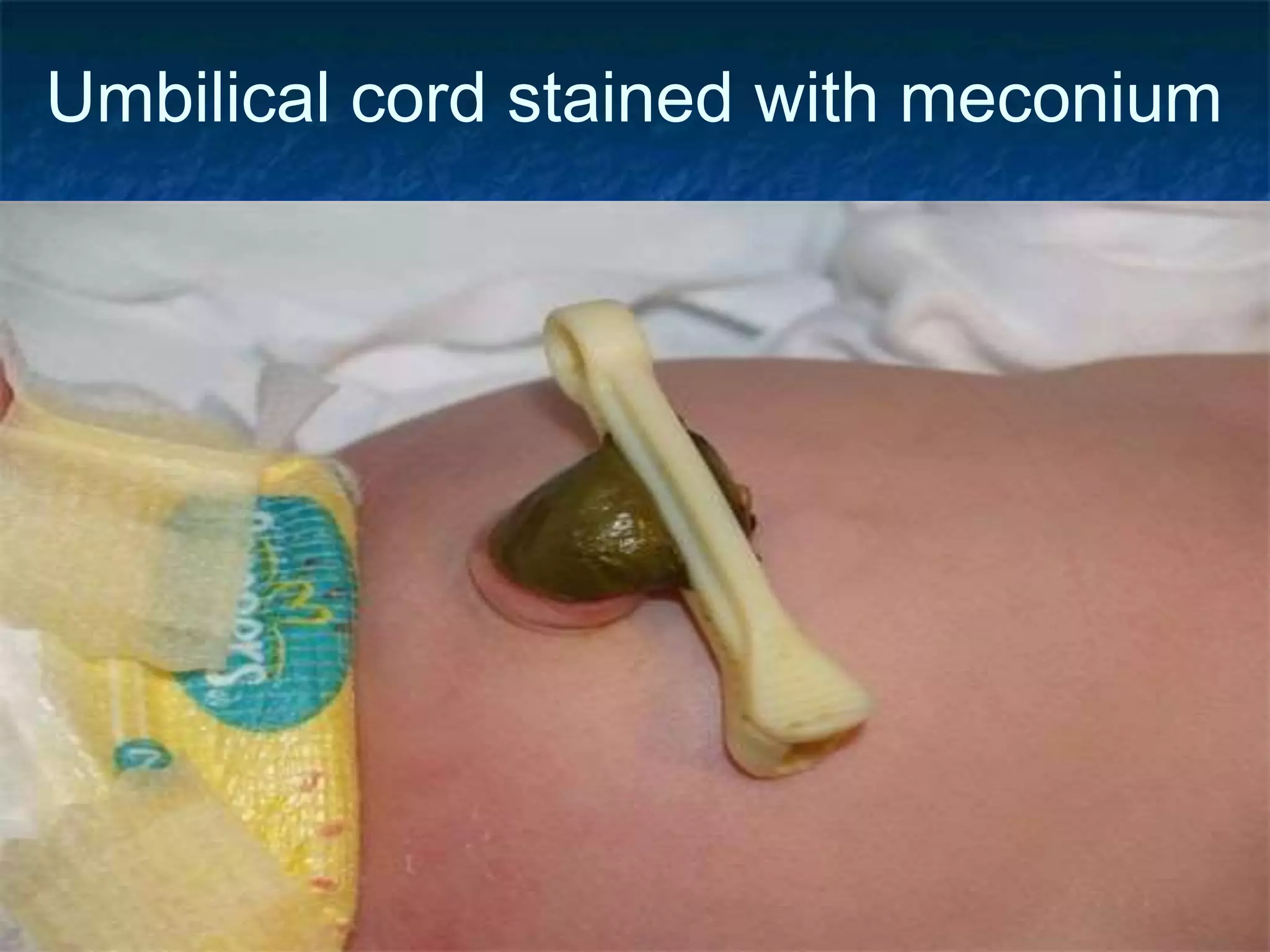 meconium aspiration syndrome- Anju.pptx