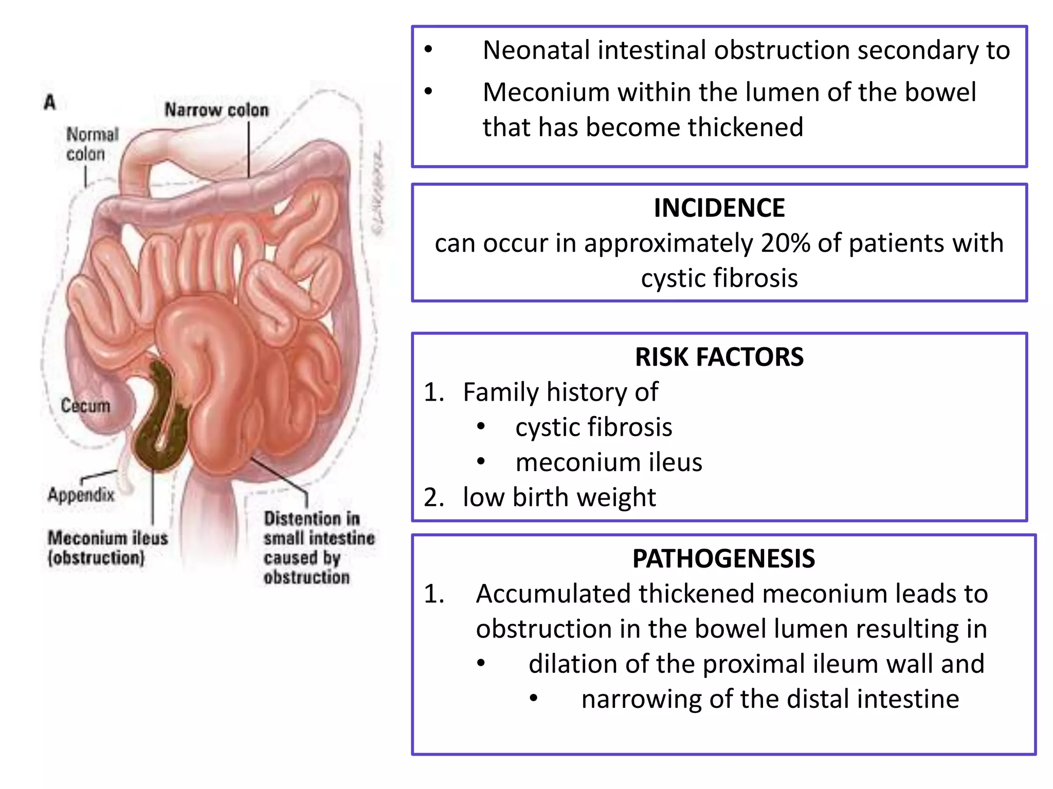 Meconium ileus Simple | PPTX