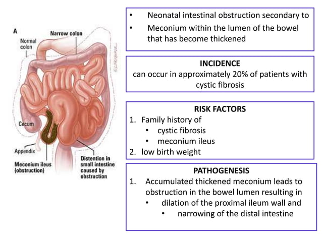 Meconium ileus Simple | PPTX | Digestive Disorders | Diseases and ...