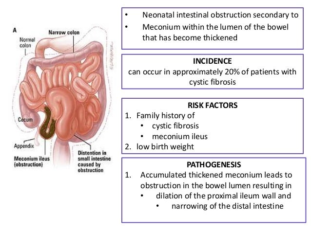 Meconium ileus Simple