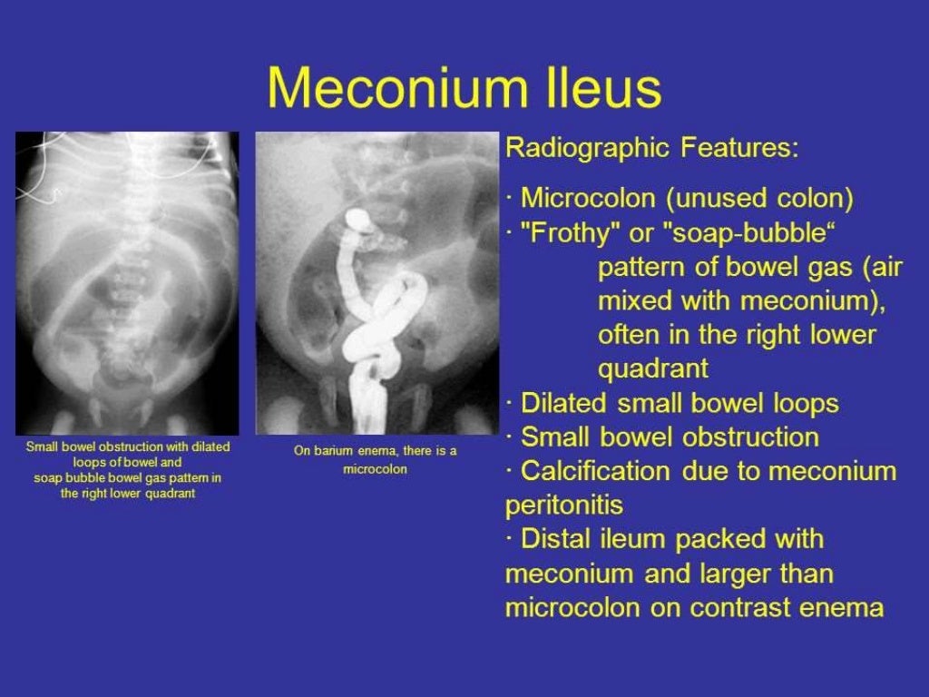Meconium ileus Simple