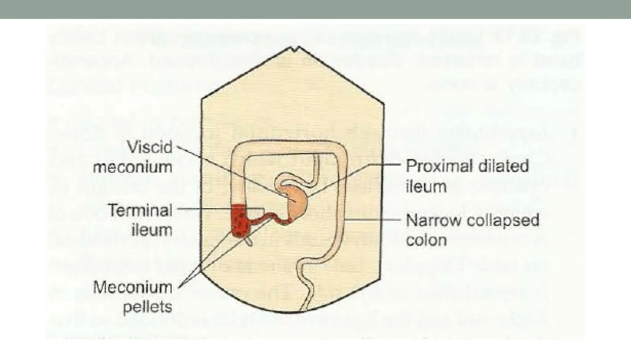 Meconium ileus and peritonitis-1 in children.pptx