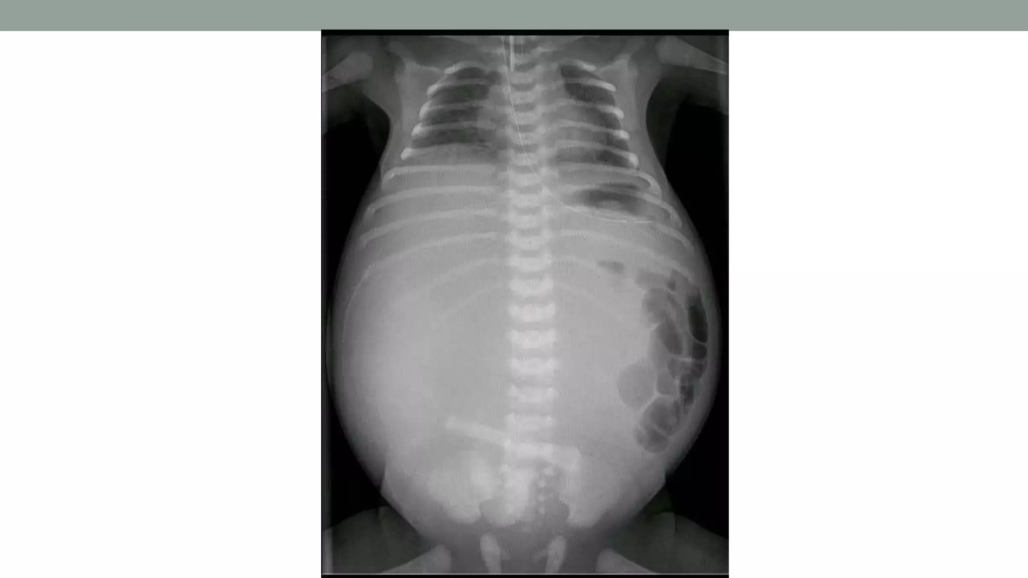 Meconium Ileus And Peritonitis Pptx