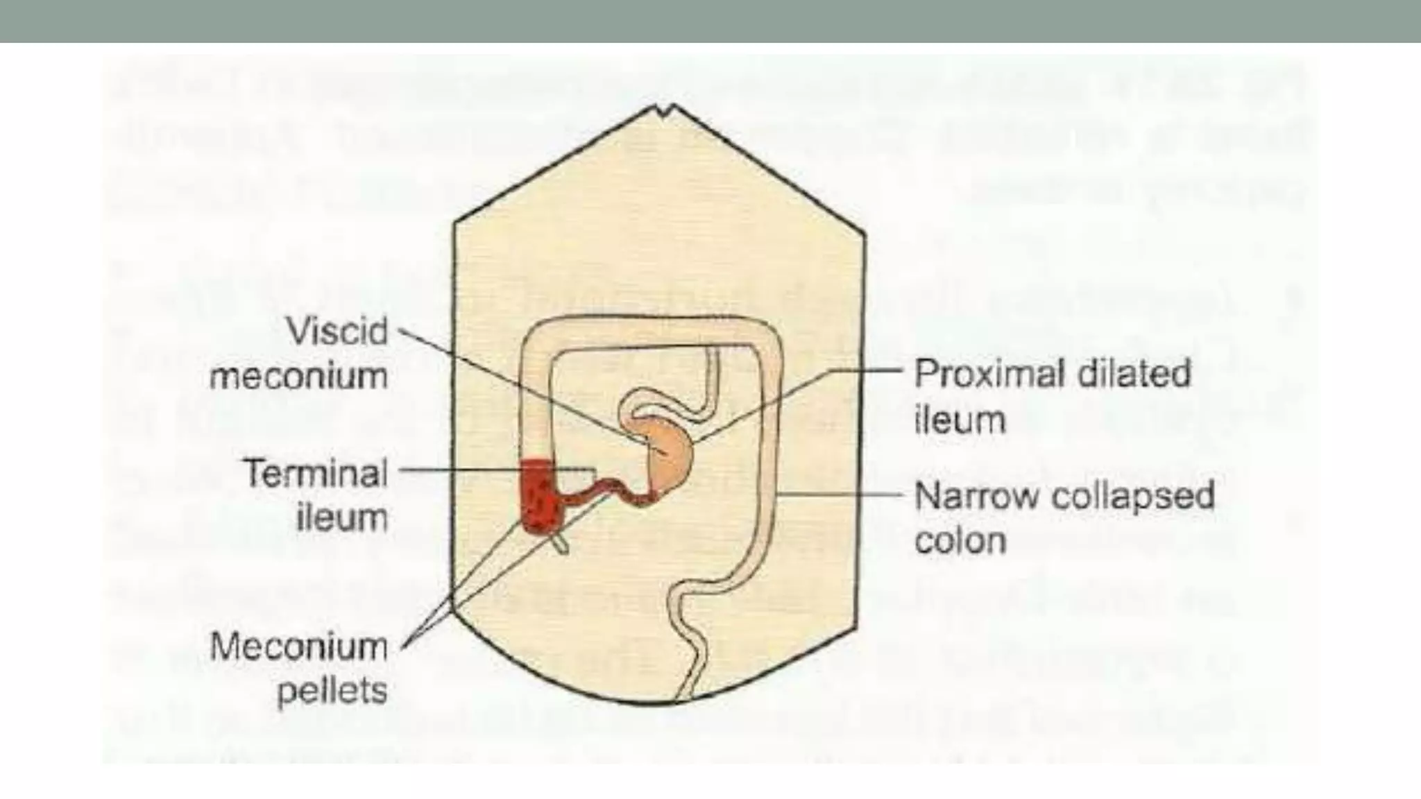 Meconium Ileus And Peritonitis Pptx
