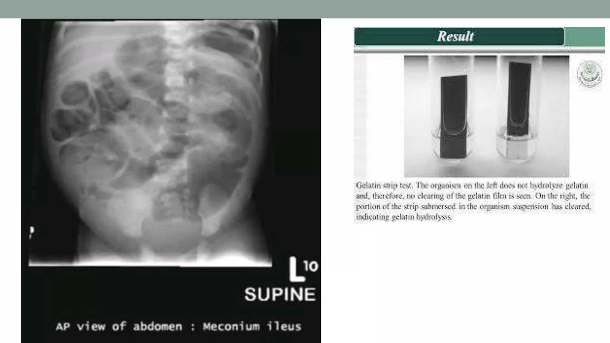 Meconium Ileus And Peritonitis Pptx