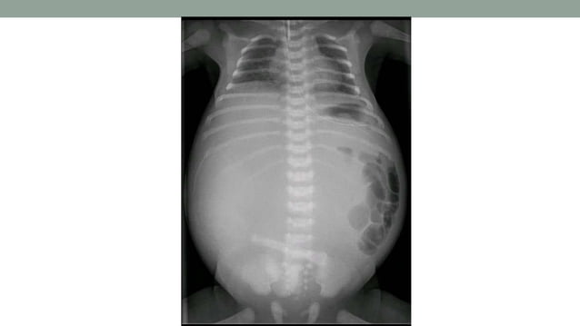 Meconium ileus and peritonitis.pptx