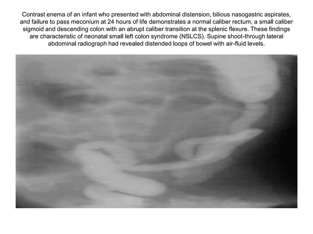 Meconium ileus case presentation | PPTX | Pregnancy | Reproductive Health