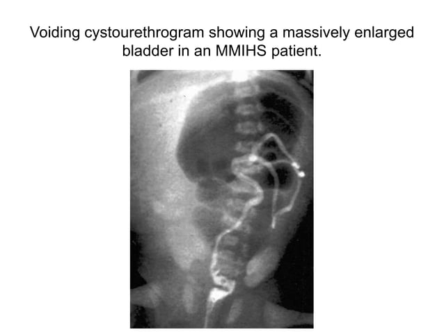 Meconium ileus case presentation | PPTX | Pregnancy | Reproductive Health