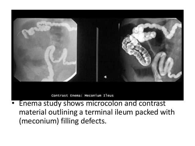 Meconium ileus case presentation