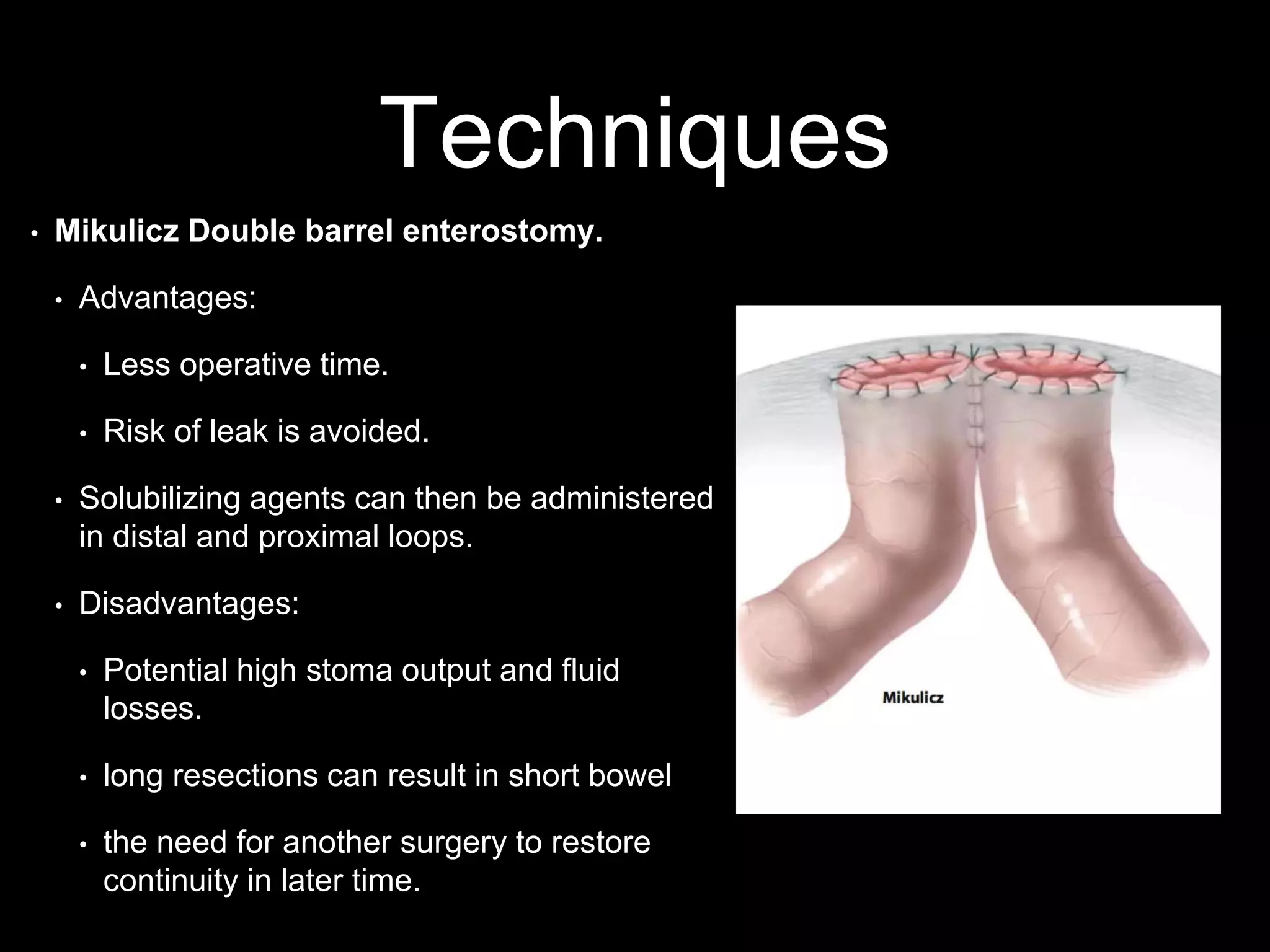 Meconium ileus surgical management | PPTX