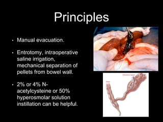 Meconium ileus surgical management | PPTX