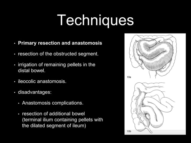Meconium ileus surgical management | PPT
