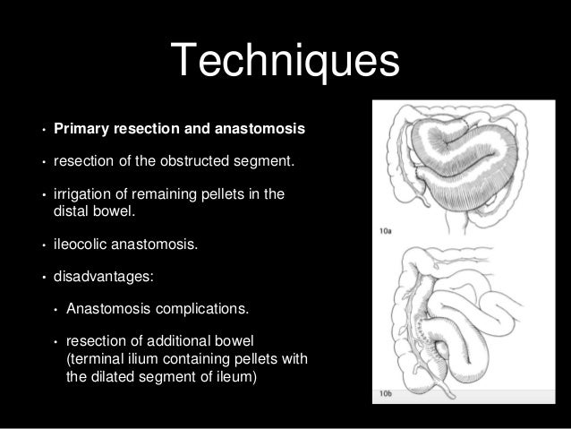 Meconium ileus surgical management