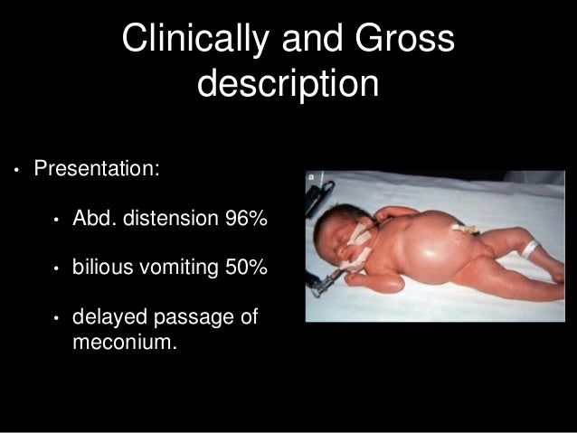 Meconium ileus surgical management
