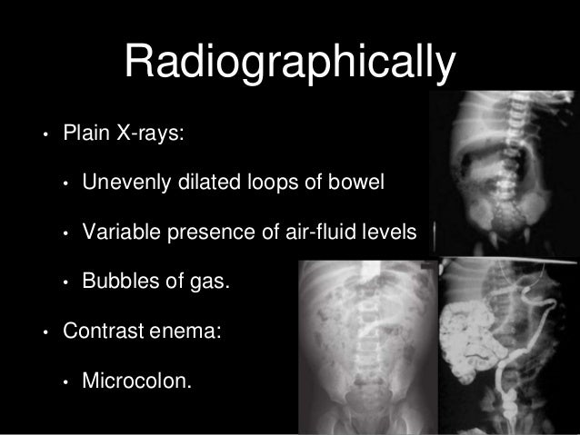 Meconium ileus surgical management