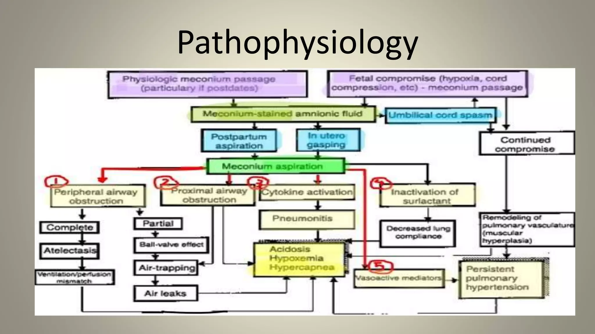 Meconium stained amniotic fluid aspiration syndrome | PPTX