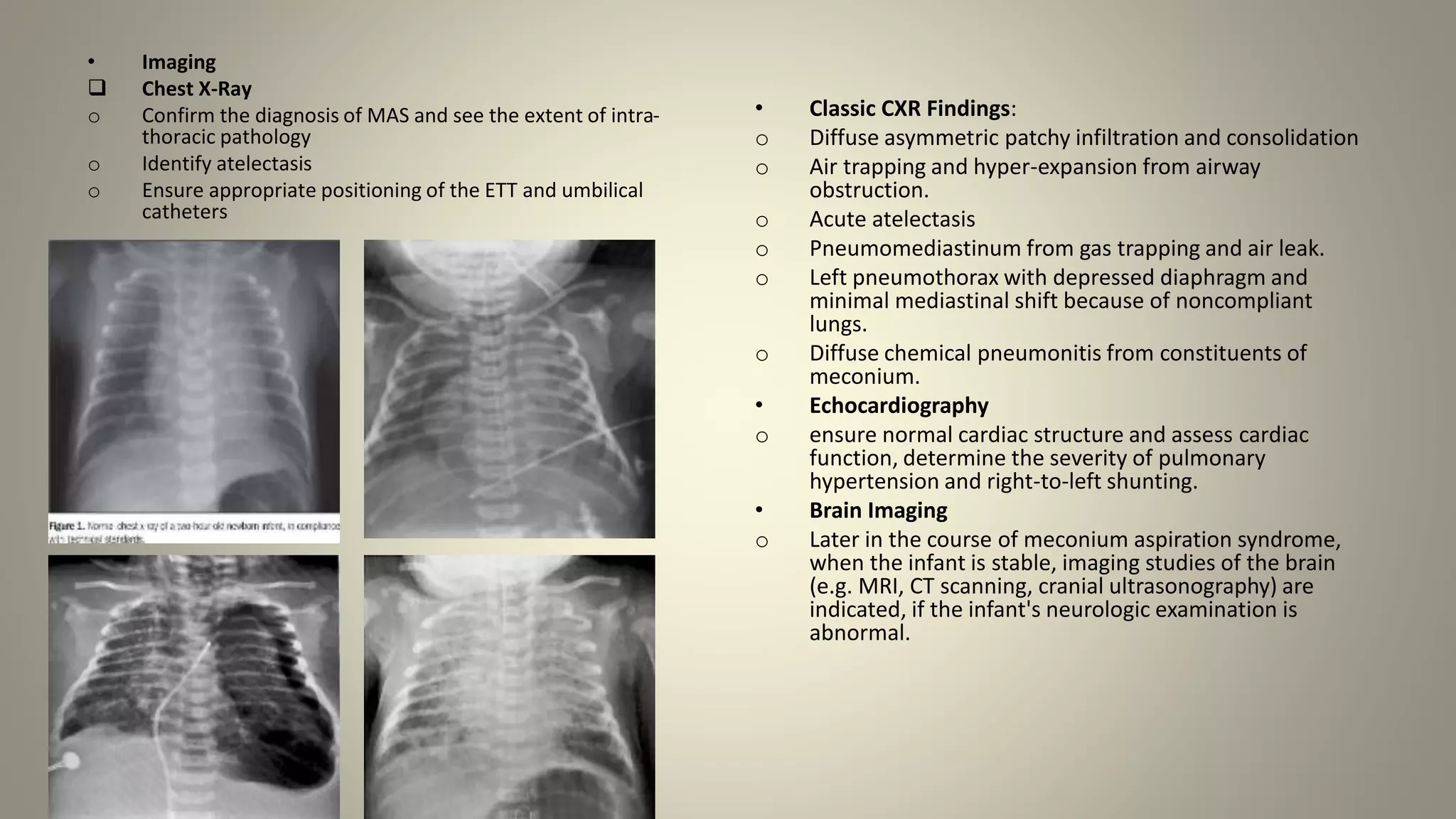 Meconium stained amniotic fluid aspiration syndrome | PPTX