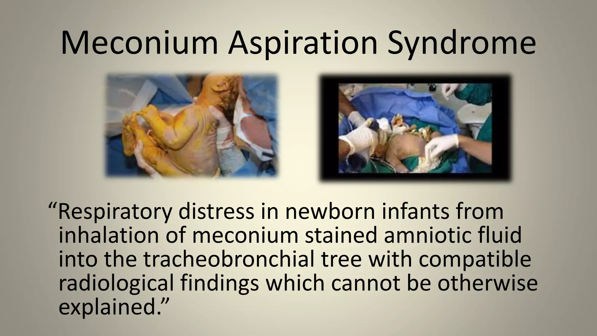 Meconium stained amniotic fluid aspiration syndrome | PPTX