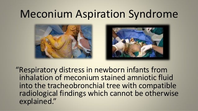 Meconium stained amniotic fluid aspiration syndrome