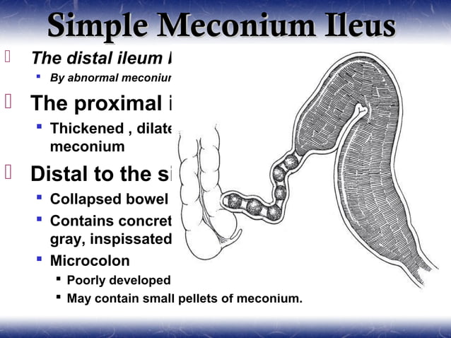 Meconium syndrome and short bowel syndrome | PPT | Digestive Disorders ...