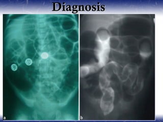 Meconium syndrome and short bowel syndrome | PPT