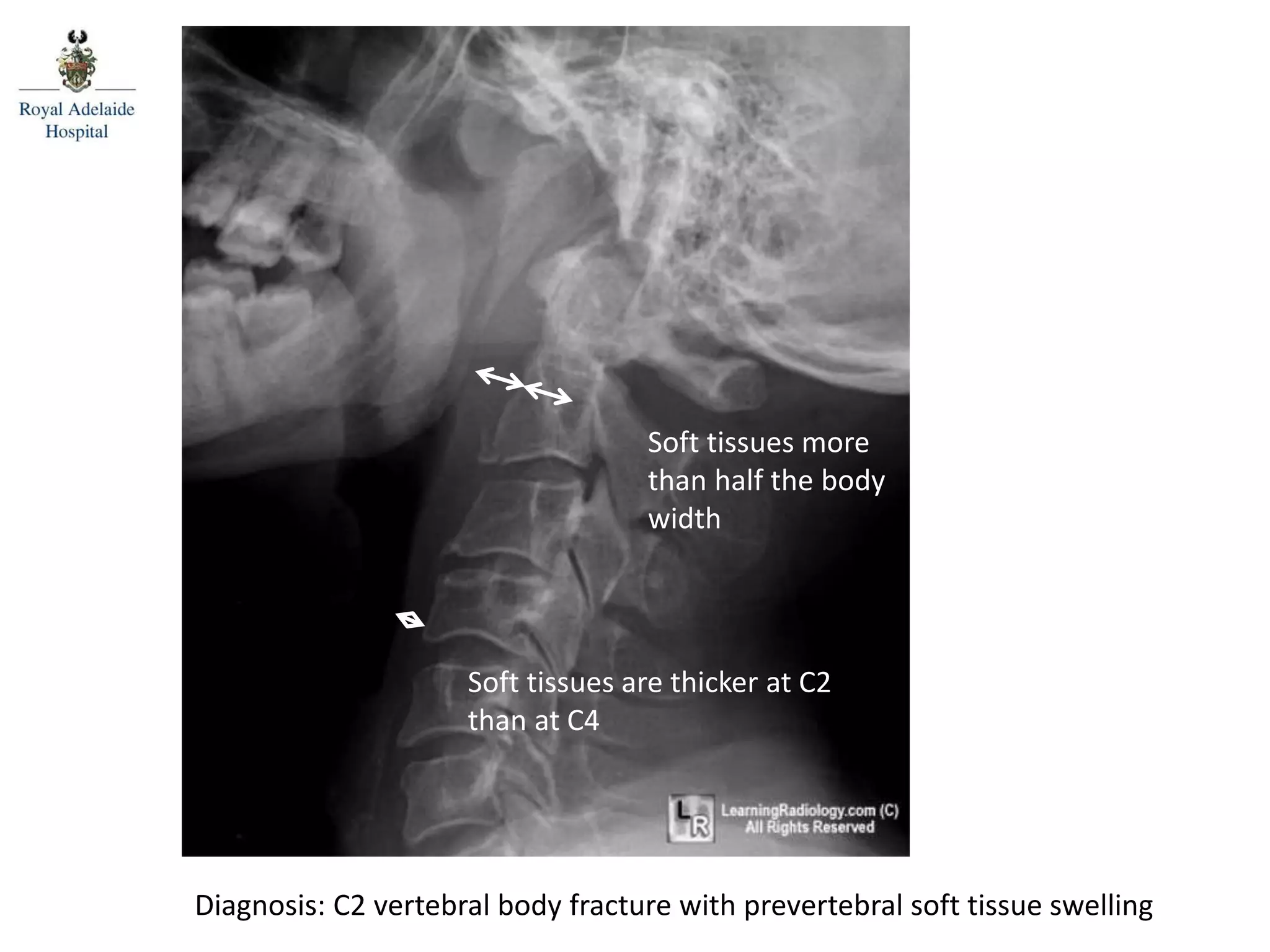 Med 4 ortho spinal cases | PPTX