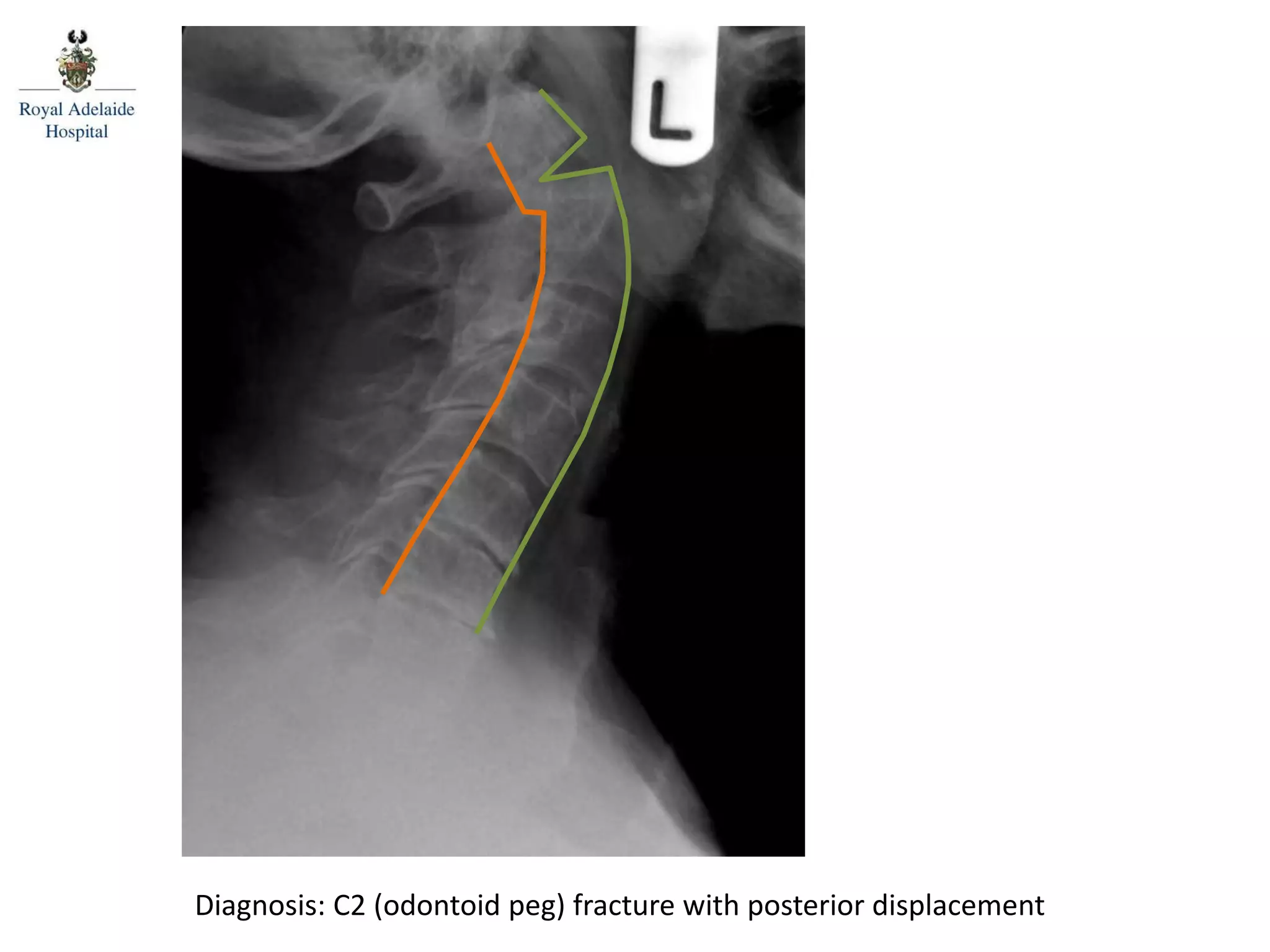 Med 4 ortho spinal cases | PPTX