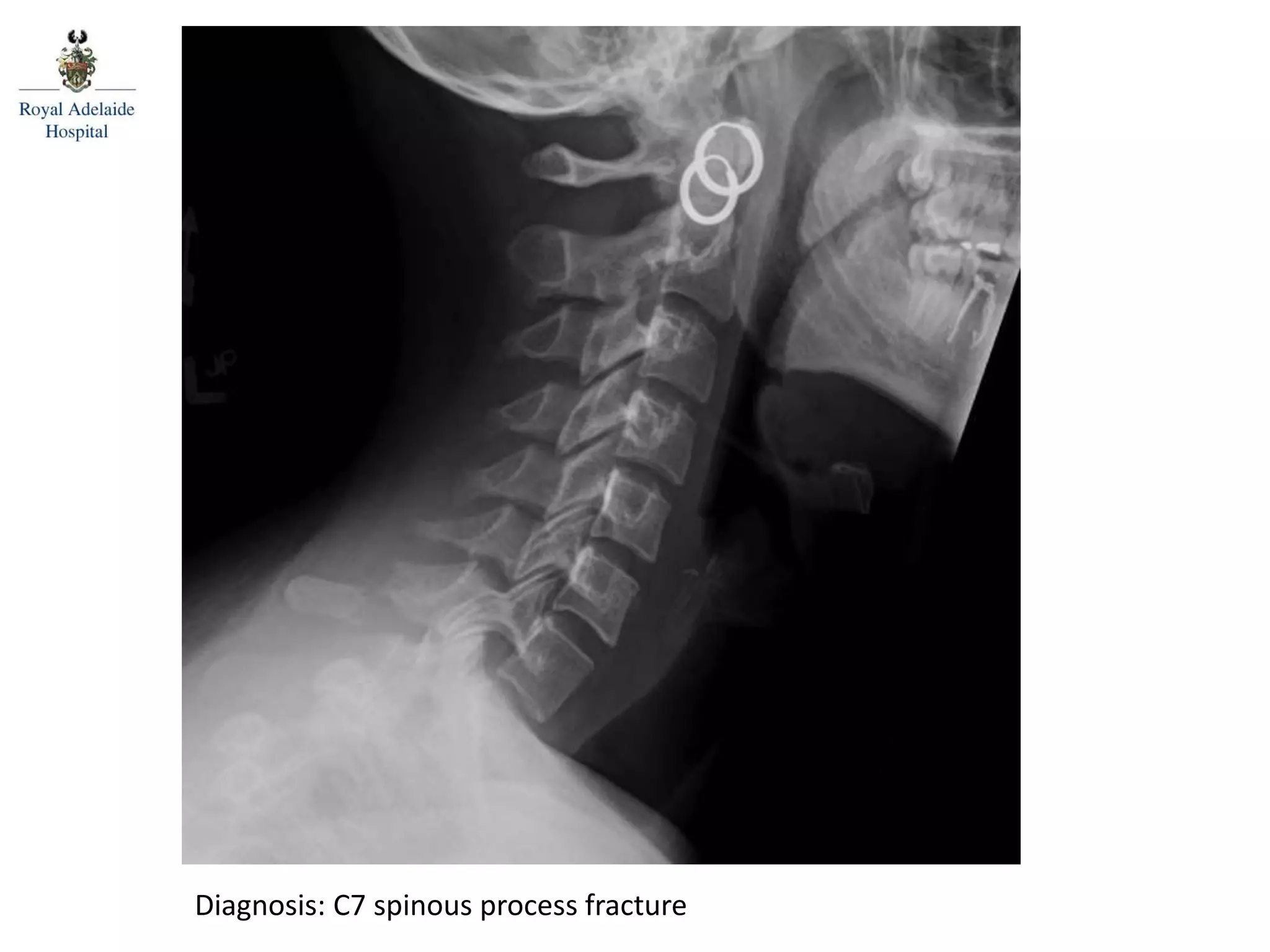 Med 4 ortho spinal cases | PPTX