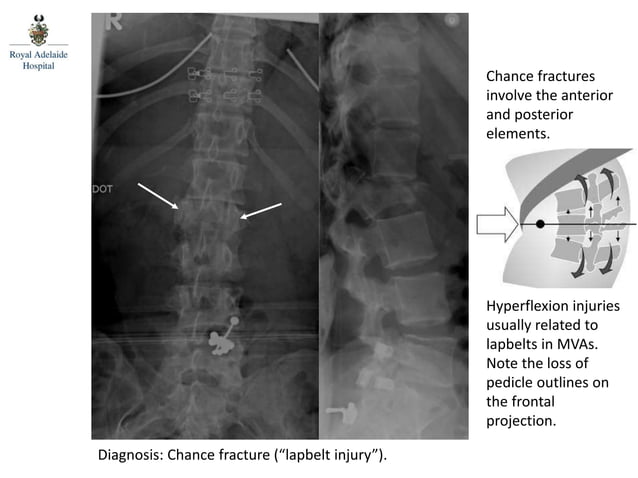 Med 4 ortho spinal cases | PPTX