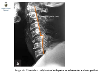 Med 4 ortho spinal cases | PPTX