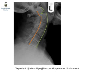 Med 4 ortho spinal cases | PPTX