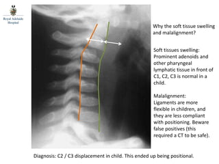 Med 4 ortho spinal cases | PPTX