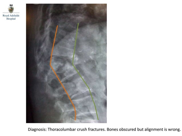 Med 4 ortho spinal cases | PPTX
