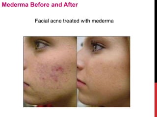 Acne Scars Before And After Mederma