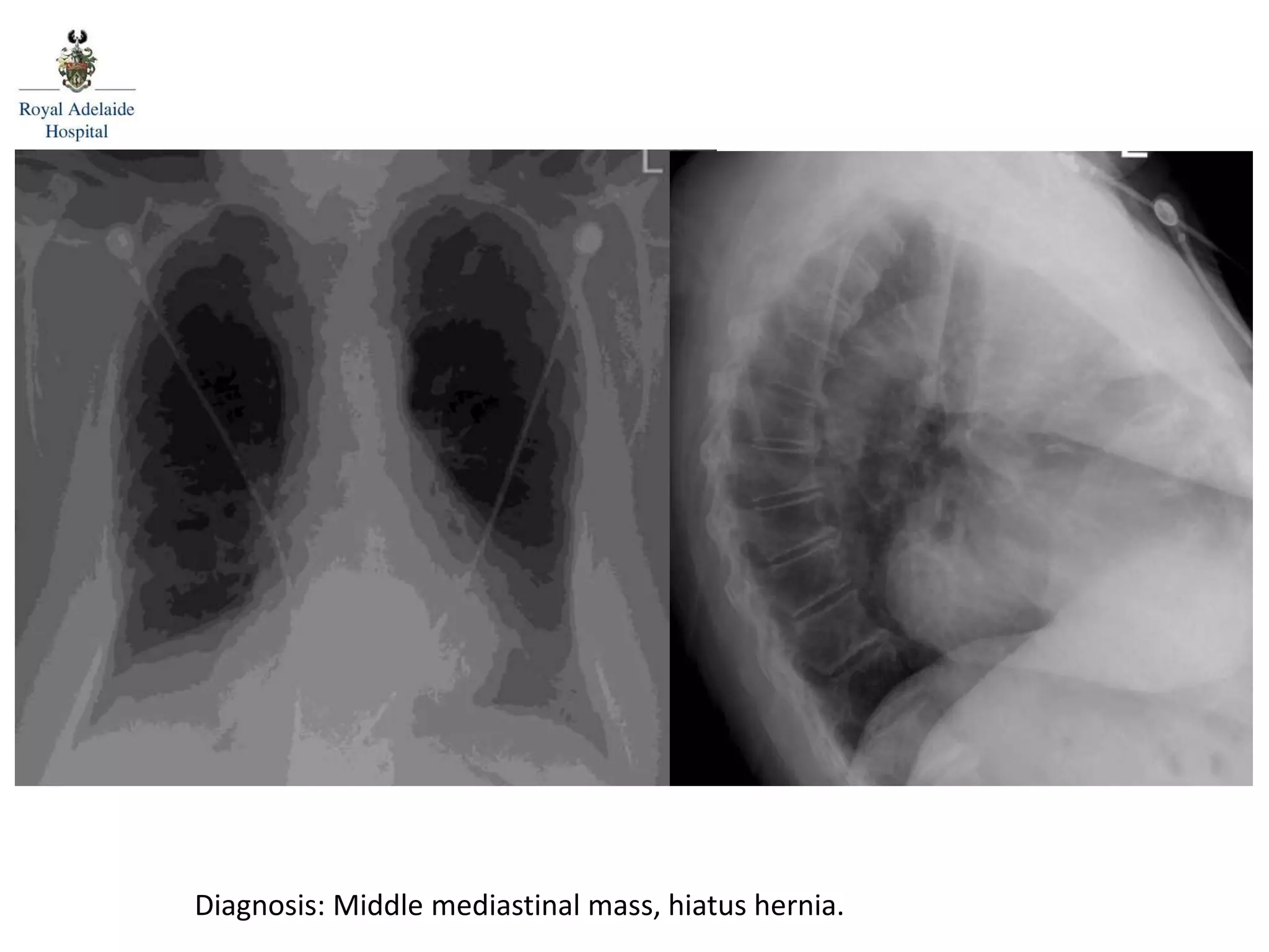 Med home unit chest cases 2 | PPTX