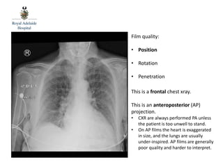 RAH Med 4 MHU - Chest Xray 1 | PPTX