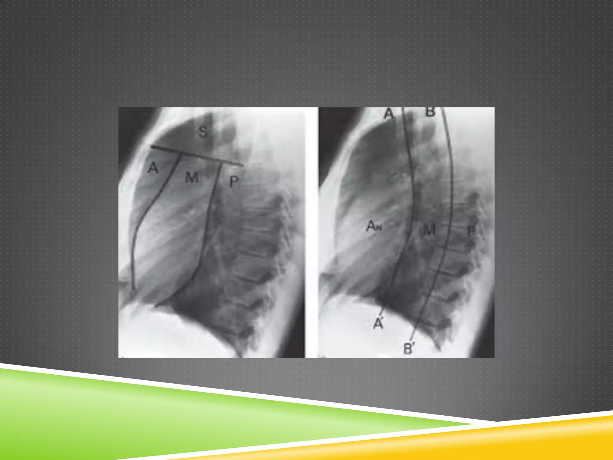 CT ANATOMY OF NORMAL MEDIASTINUM MADE EASY | PPTX
