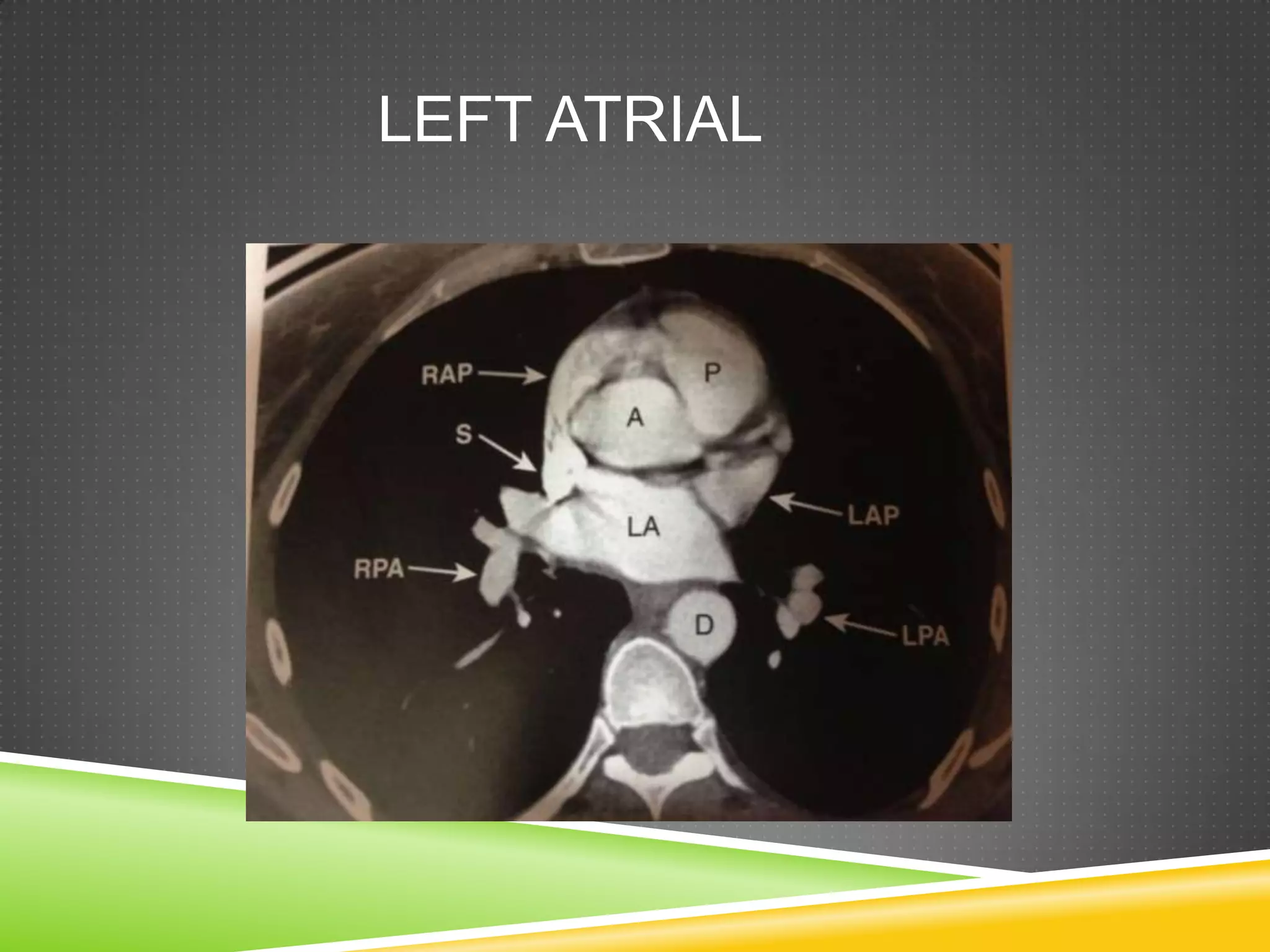 CT ANATOMY OF NORMAL MEDIASTINUM MADE EASY | PPTX