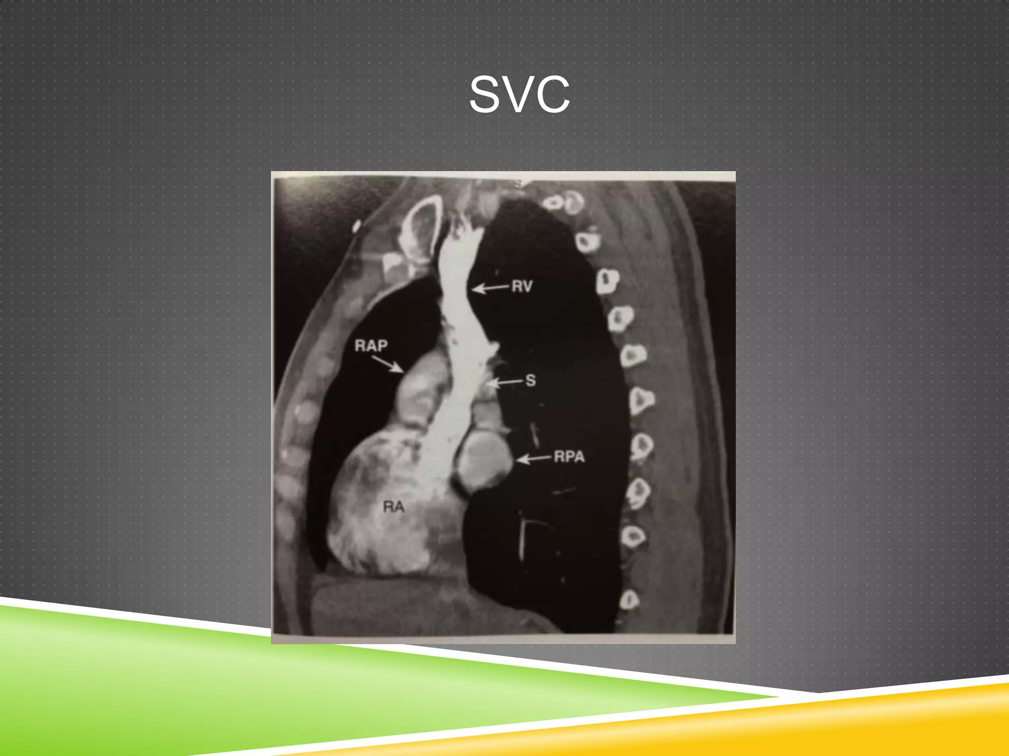 CT ANATOMY OF NORMAL MEDIASTINUM MADE EASY | PPTX