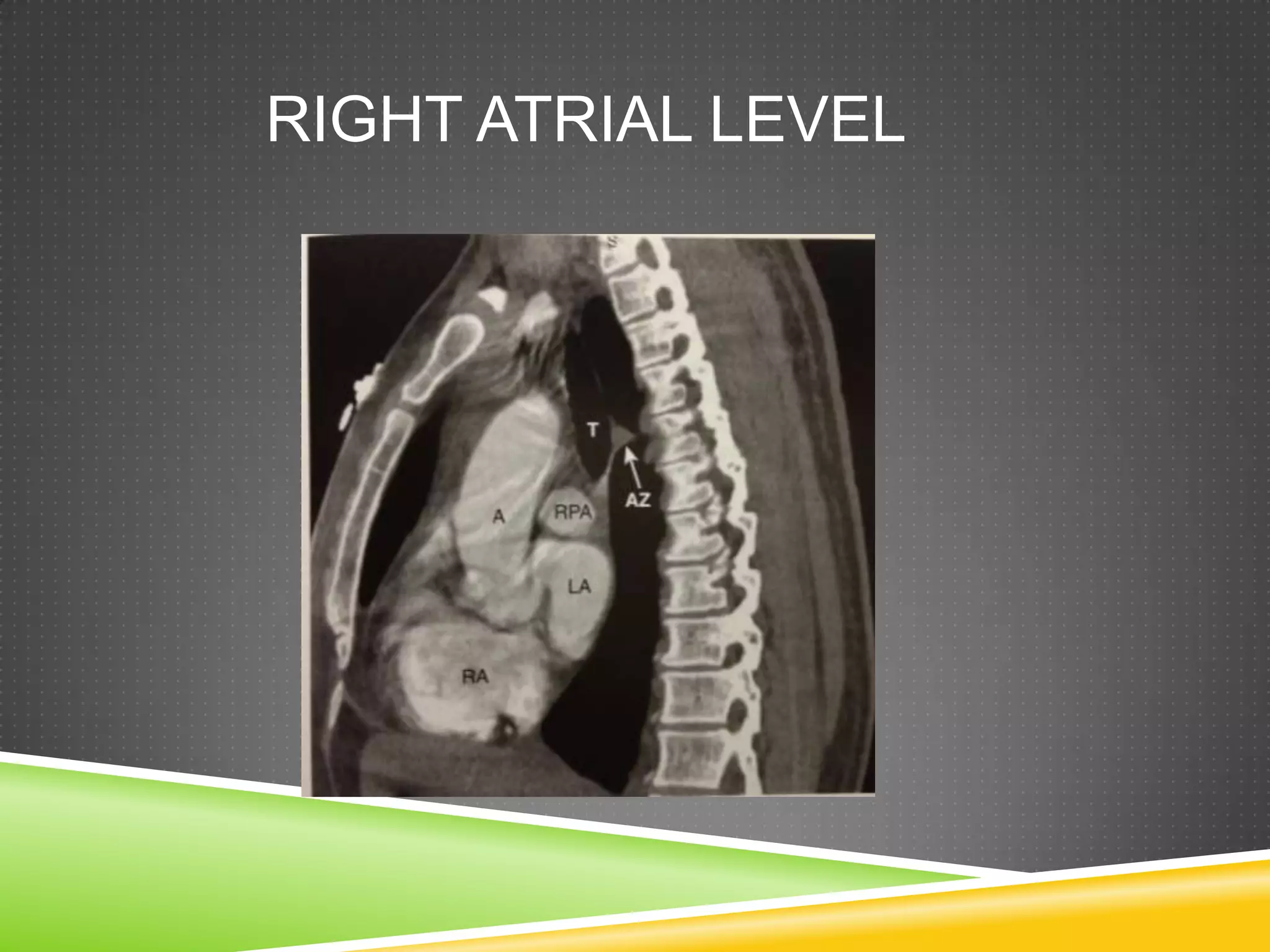 CT ANATOMY OF NORMAL MEDIASTINUM MADE EASY | PPTX