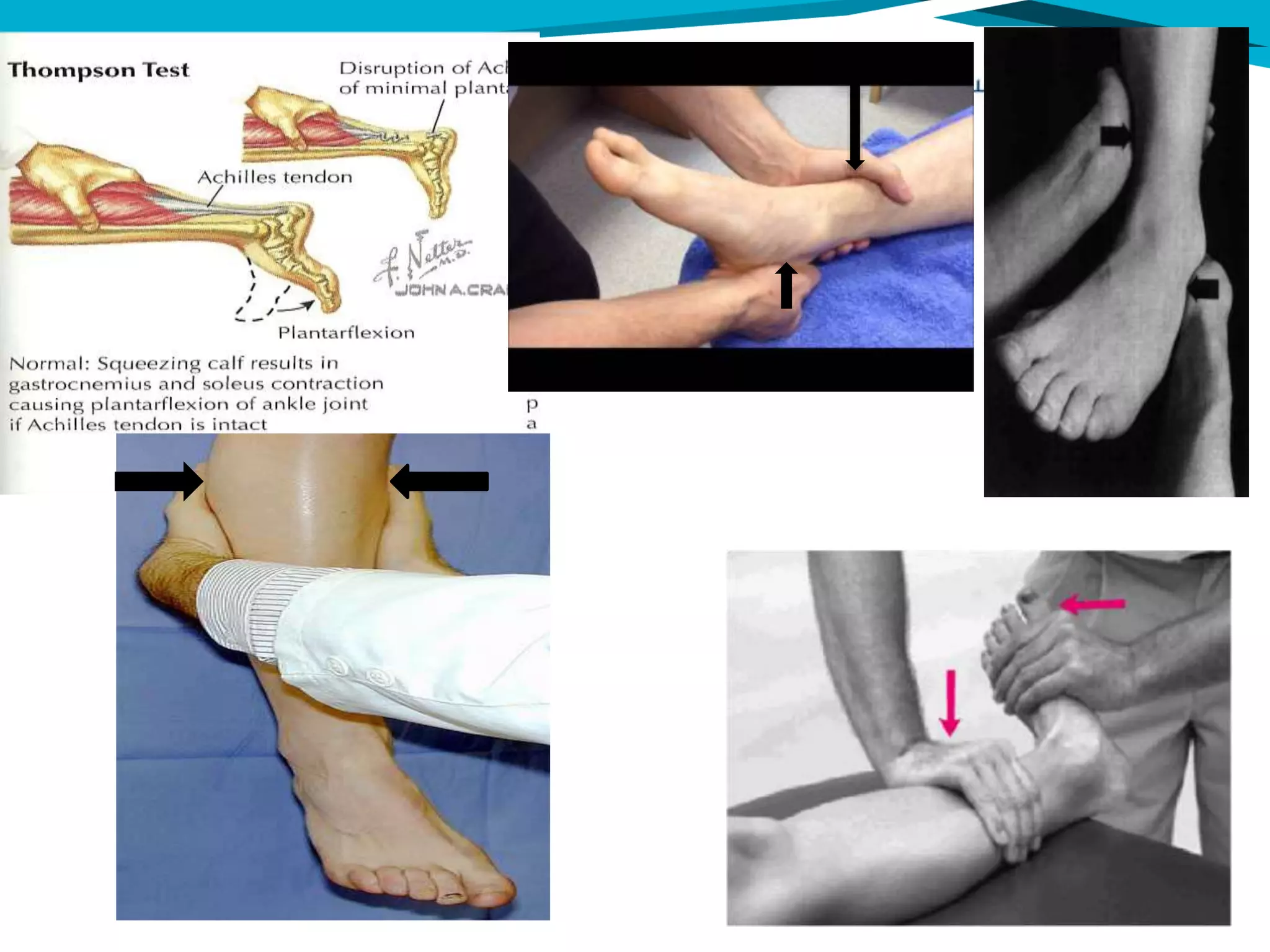 Medial ankle sprain | PPT