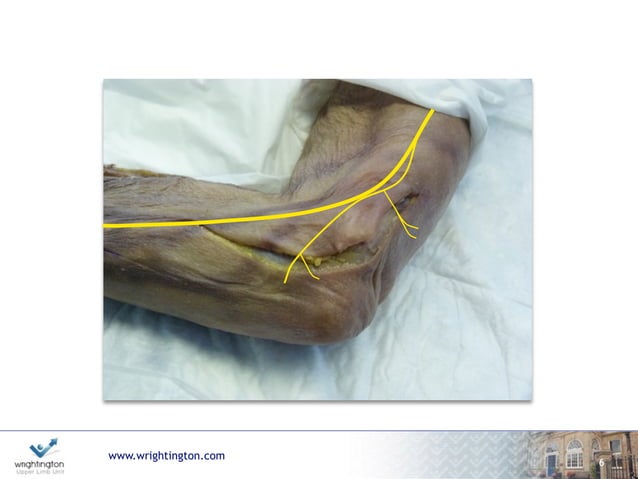 Medial approaches elbow | PDF | Death, Injury, or Military Conflict ...