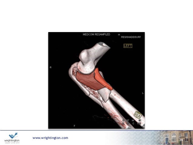Medial approaches elbow