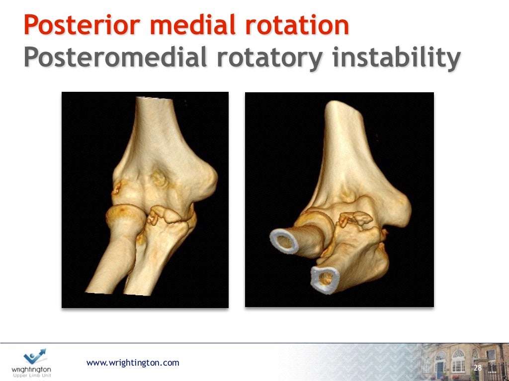 Medial approaches elbow