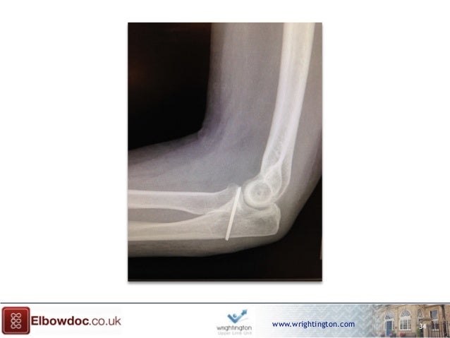 Medial Approaches Elbow
