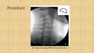 Cervical spine Medial branch block procedure | PPTX