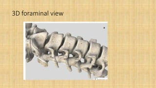 Cervical spine Medial branch block procedure | PPTX